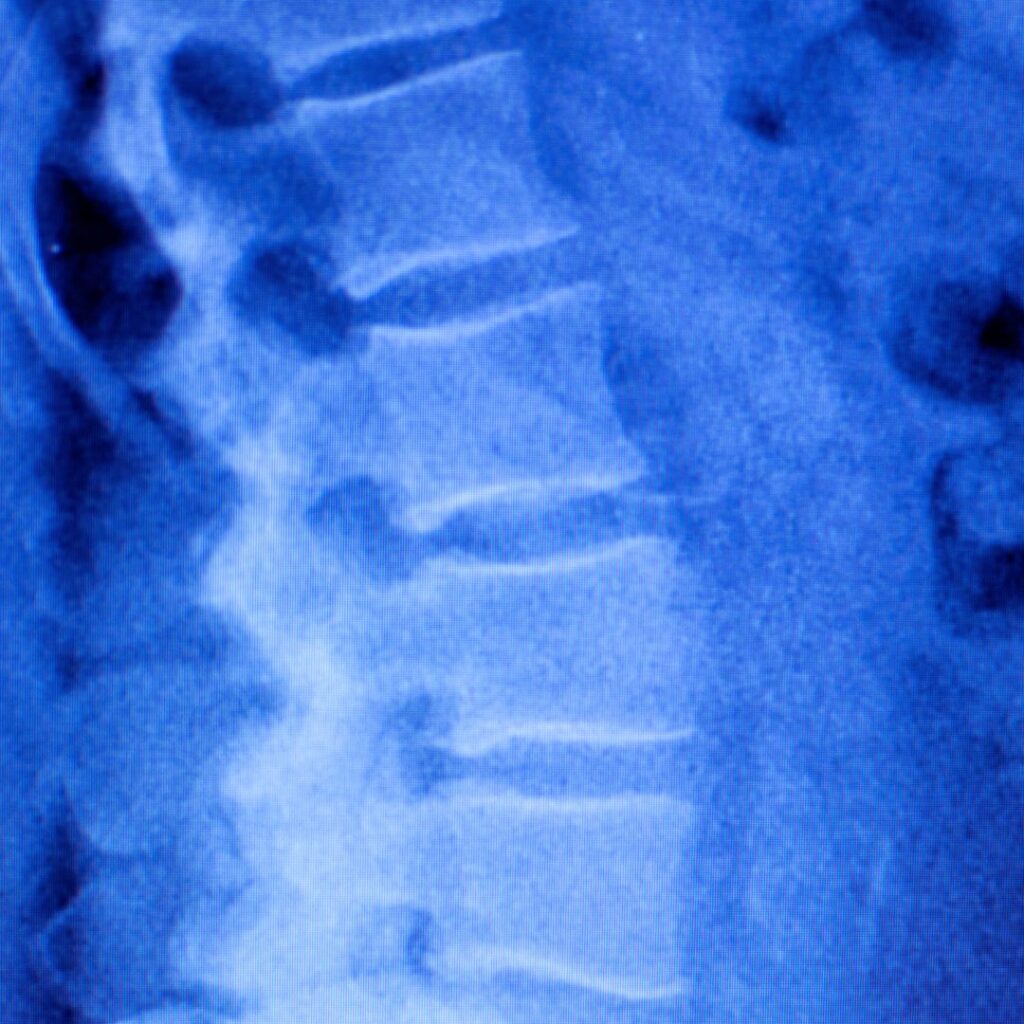 Common Minimally Invasive Back Surgeries - Call Today