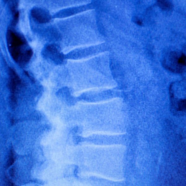 Common Minimally Invasive Back Surgeries - Call Today