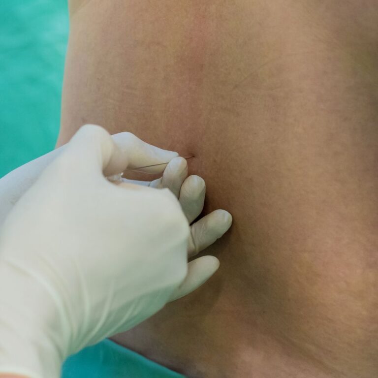 Common Spine Procedures That Utilize Epidural Injections - Central ...